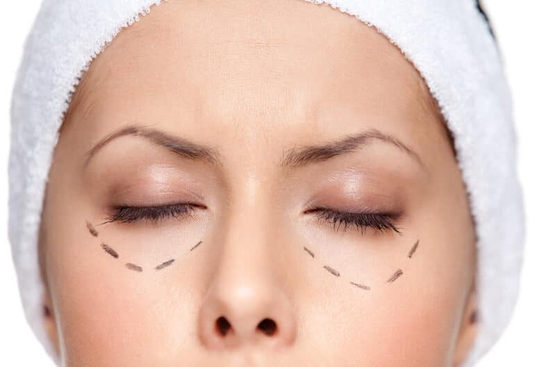 Plasma Eye Lift UK | Non-Surgical Blepharoplasty from £99